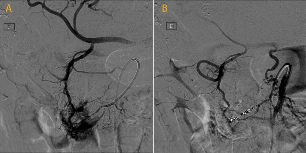 Les complications hémorragiques en radiologie interventionnelle ...