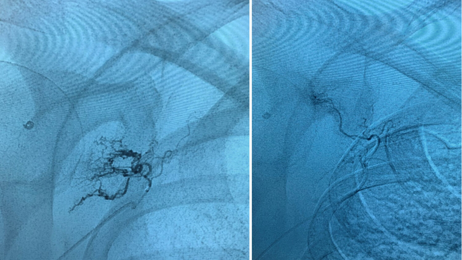 L’embolisation de la capsulite rétractile (ECR) : une innovation ...