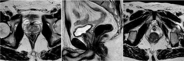 IRM de la prostate : anatomie et lésions bénignes - Docteur Imago