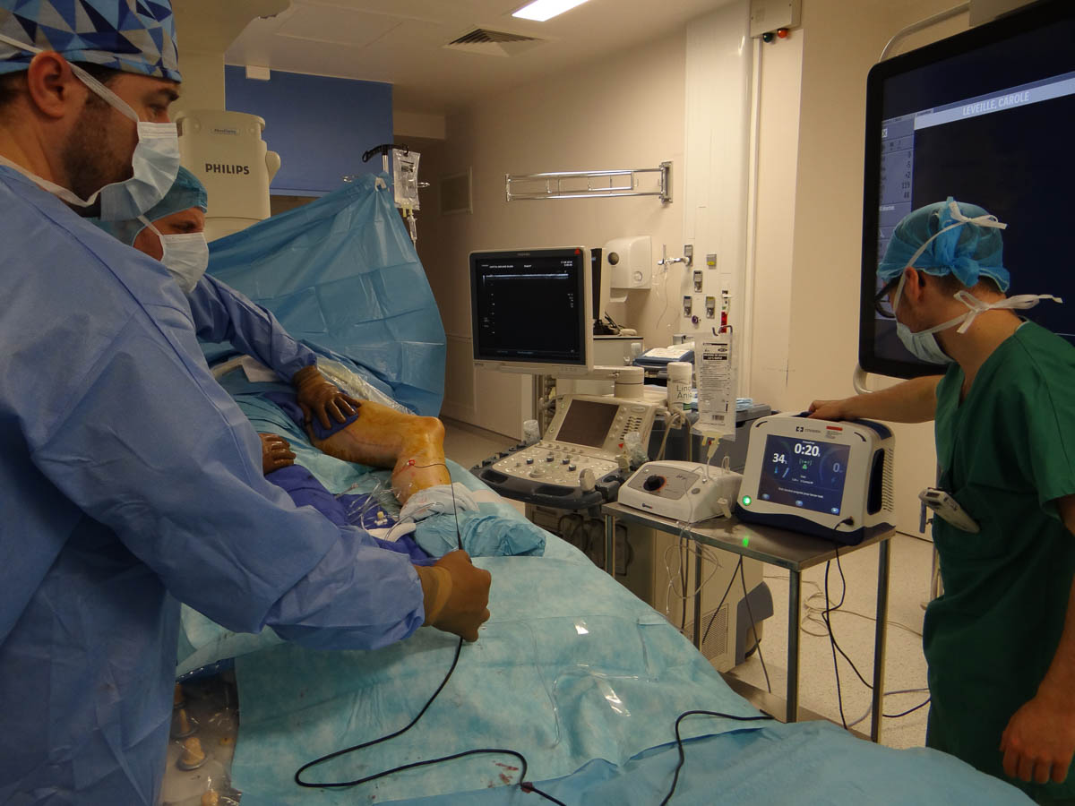 La radiofréquence efface les varices - Docteur Imago