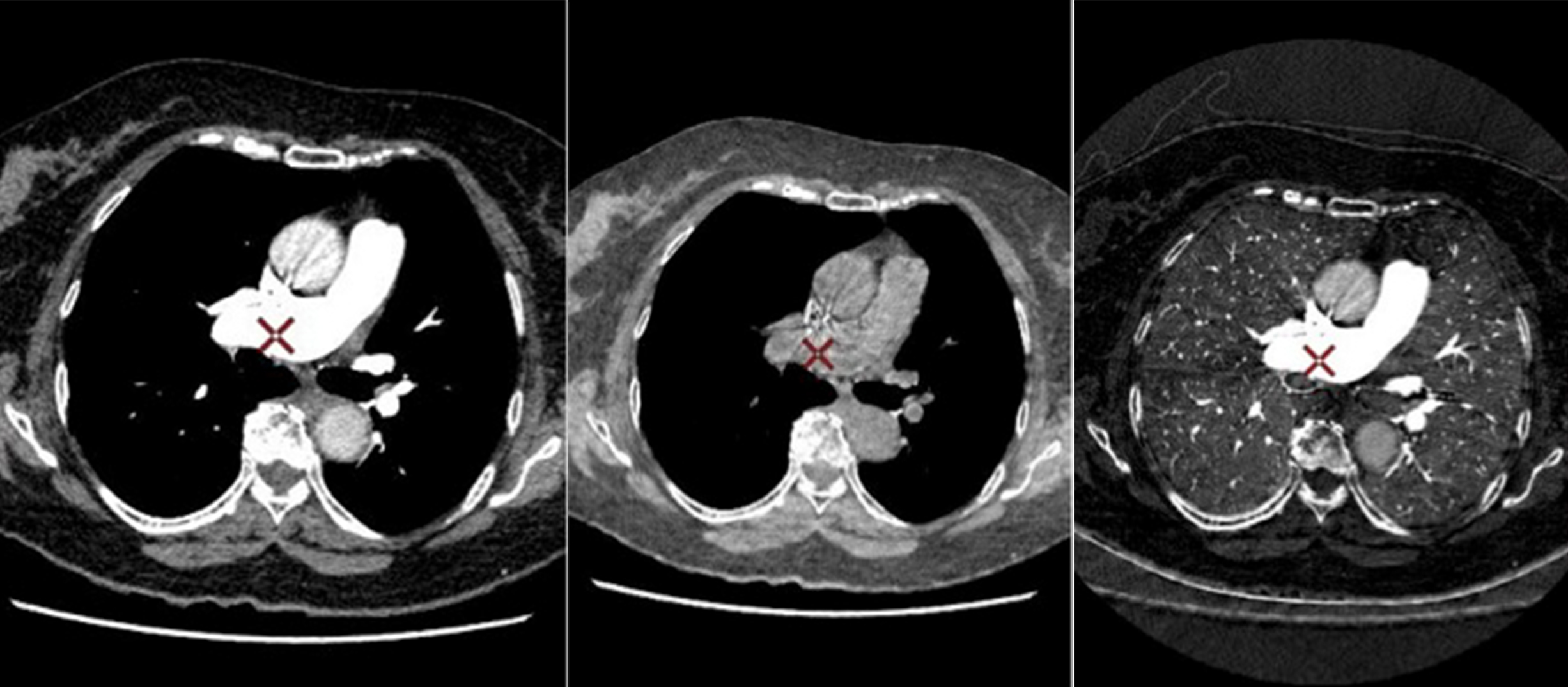 L’imagerie spectrale incontournable pour les pathologies thoraciques ...