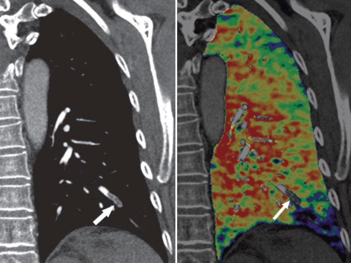Scanner double énergie : bases de la technique et rôle clinique ...
