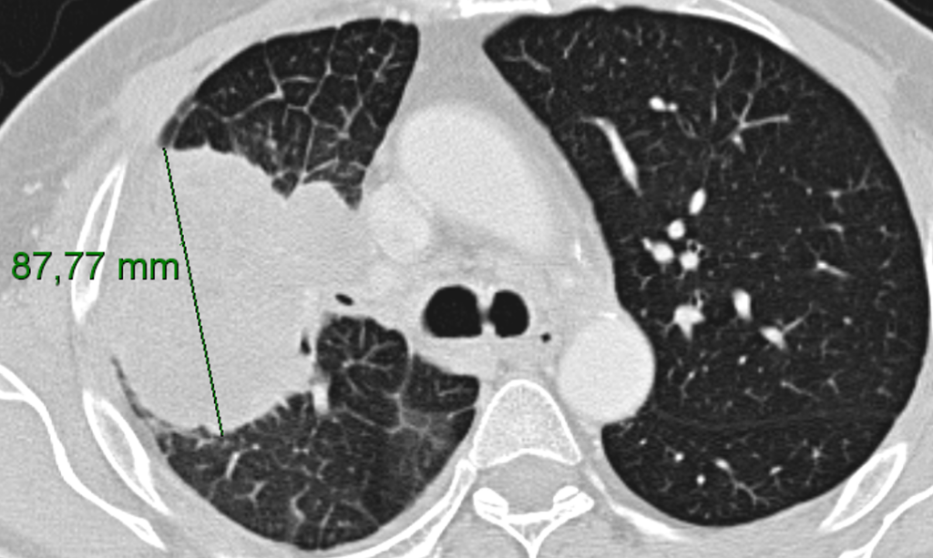 Une nouvelle classification TNM pour le cancer du poumon - Docteur Imago