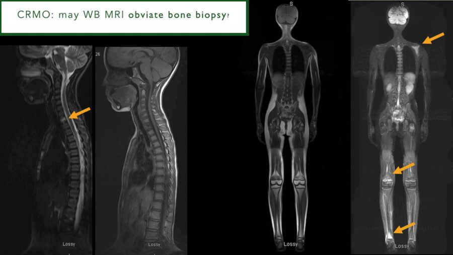 L’apport de l’IRM corps entier pour les pathologies ...