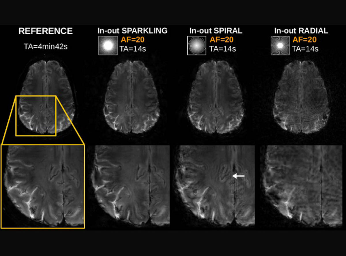 NeuroSpin accélère l'IRM ultra haut champ - Docteur Imago