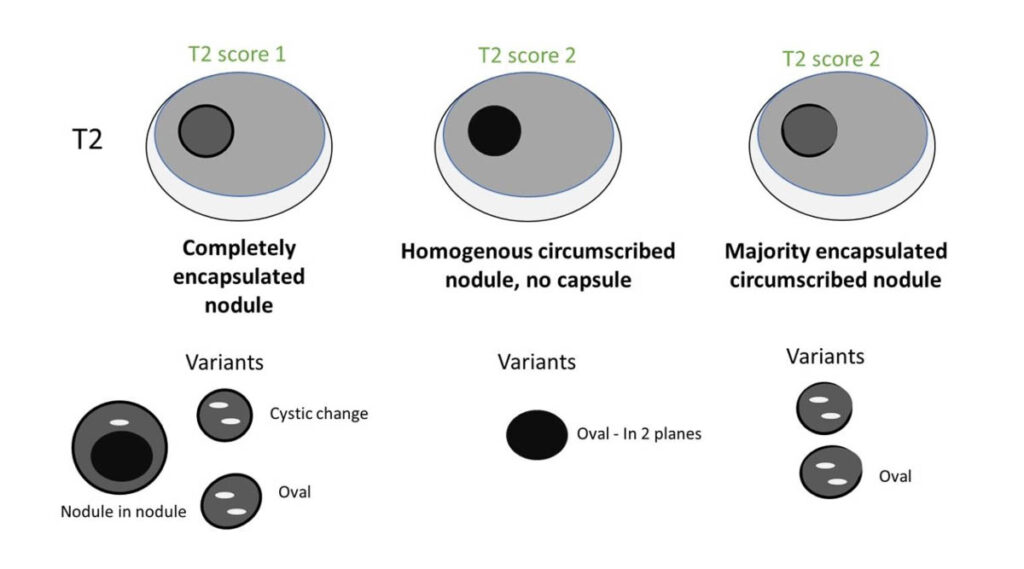 La classification PI-RADS fait sa mise à jour 2.1 - Docteur Imago