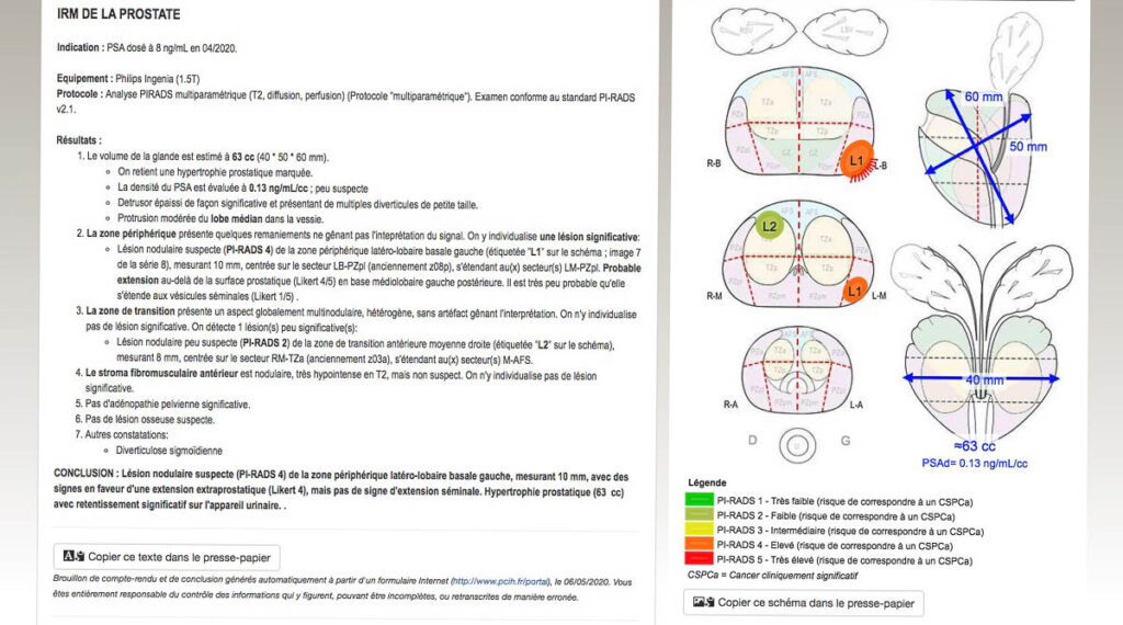 Un compte rendu structuré d'IRM de prostate en quelques clics - Docteur ...