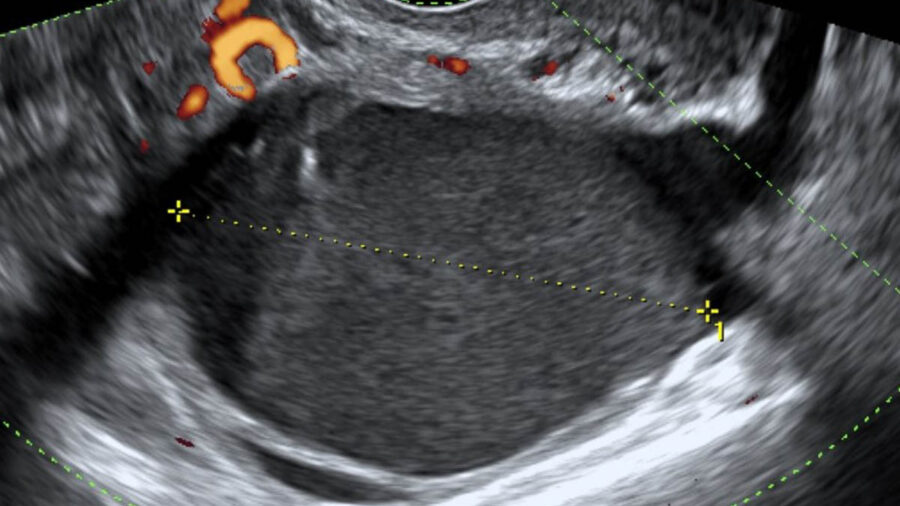 Endométriose : l’imagerie au secours des femmes - Docteur Imago