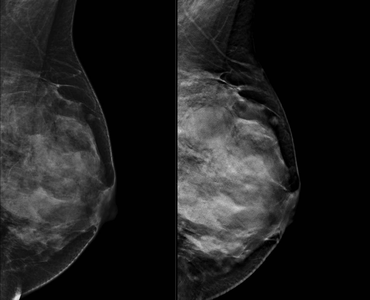 L'association mammographie - tomosynthèse améliore la sensibilité du ...