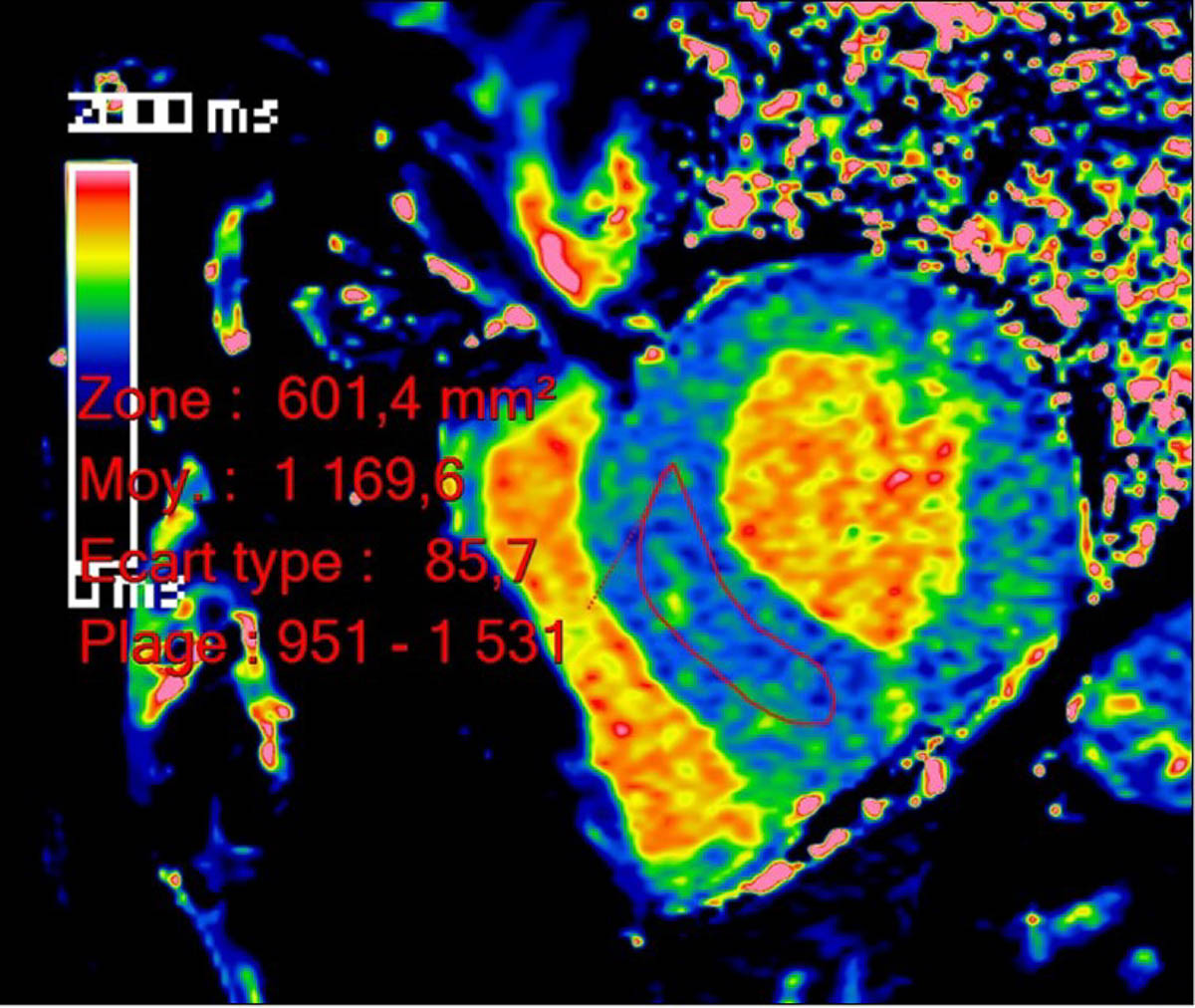 L’imagerie de l’amylose cardiaque - Docteur Imago