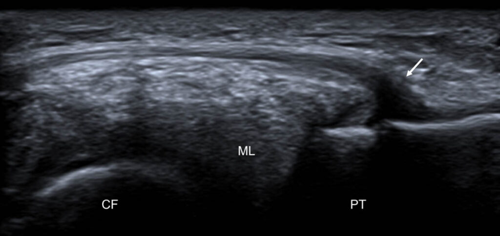 Échographie du ligament antérolatéral du genou : comment et pourquoi ...