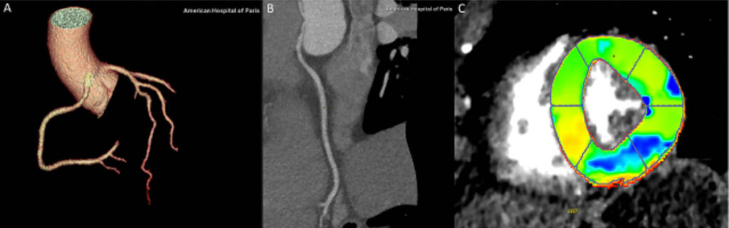 Innovation en scanner cardiaque : perfusion myocardique et FFR-CT ...