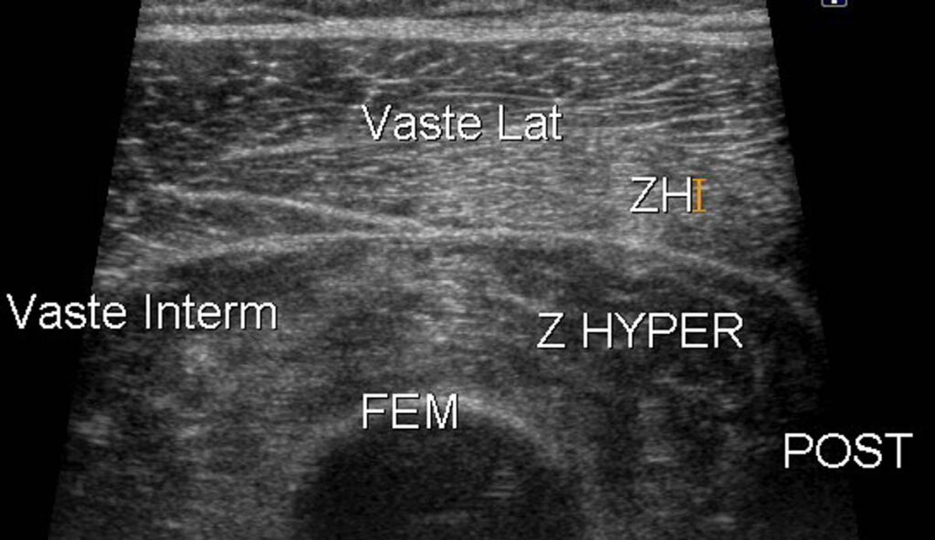Démembrement et intérêt de l’échographie des lésions musculaires ...