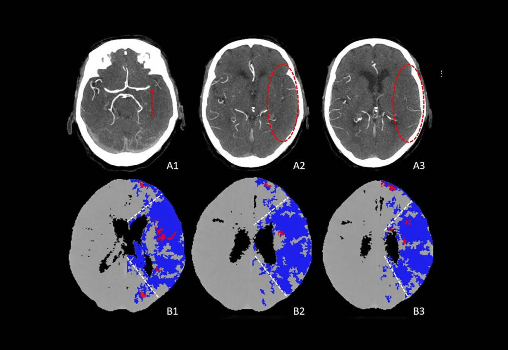 Le rôle du scanner cérébral à la phase aiguë de l’AVC - Docteur Imago