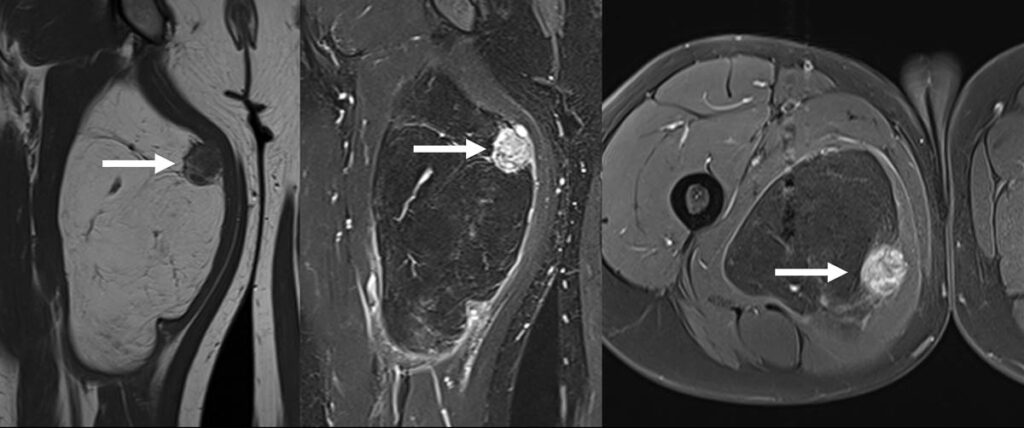 L’imagerie des sarcomes des tissus mous des extrémités - Docteur Imago