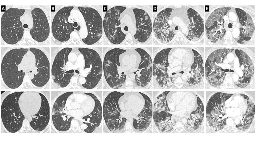 Scanner thoracique de la pneumonie COVID-19 - Docteur Imago