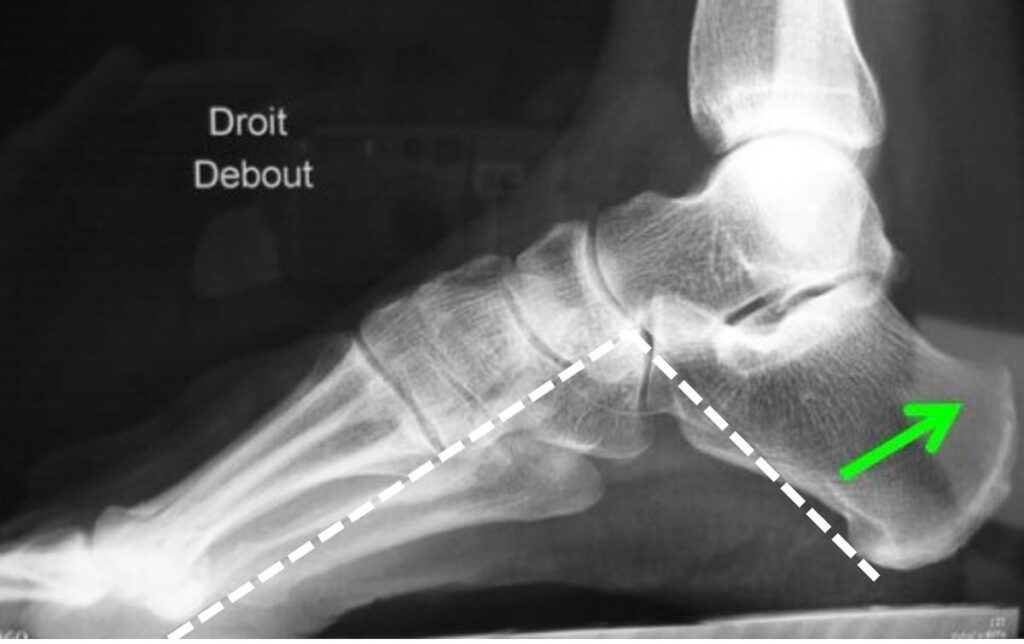 Le conflit de Haglund : causes et conséquences - Docteur Imago