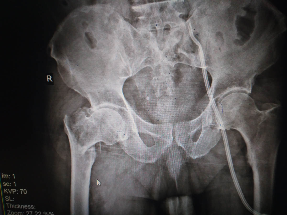 L'IA a le potentiel d’automatiser le diagnostic des fractures de la ...