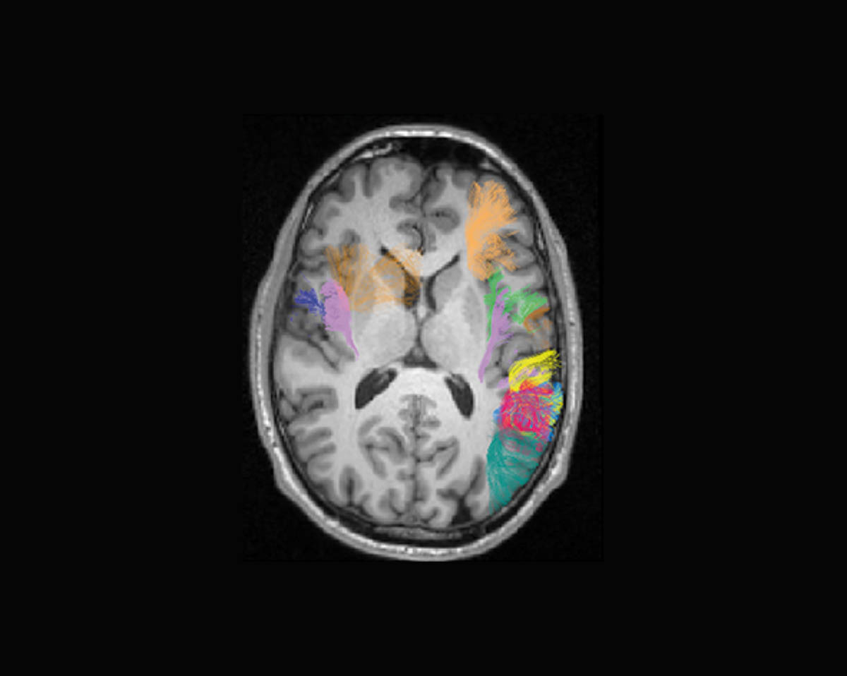 L’IRM de diffusion rebat les cartes de la compréhension de l’autisme ...