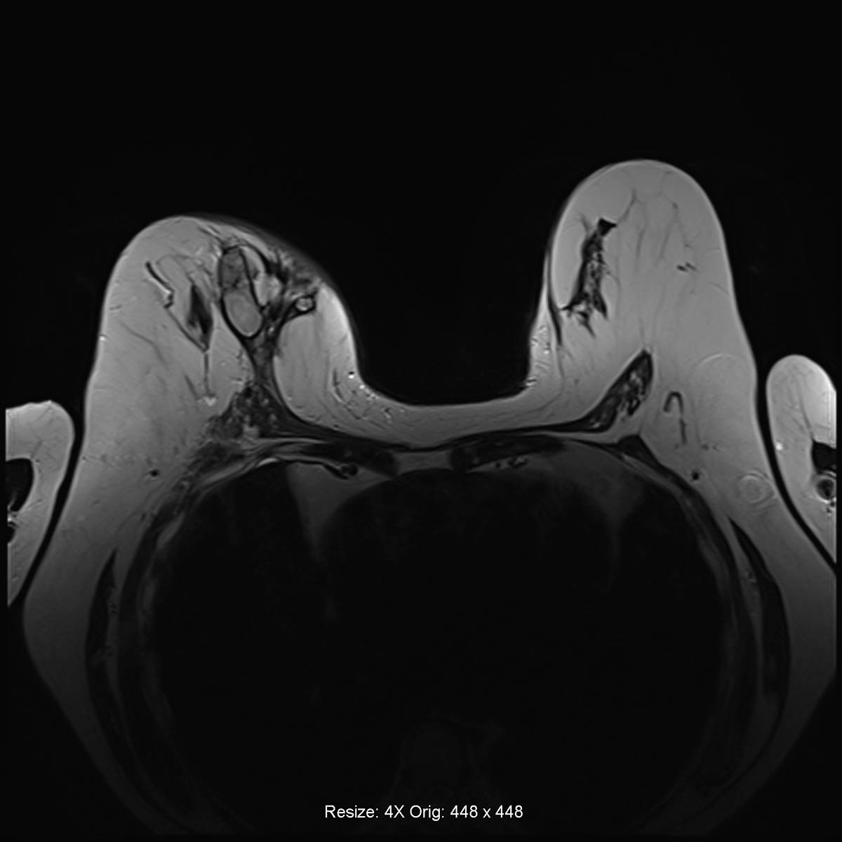 IRM mammaire : indications, technique de réalisation et bases d ...