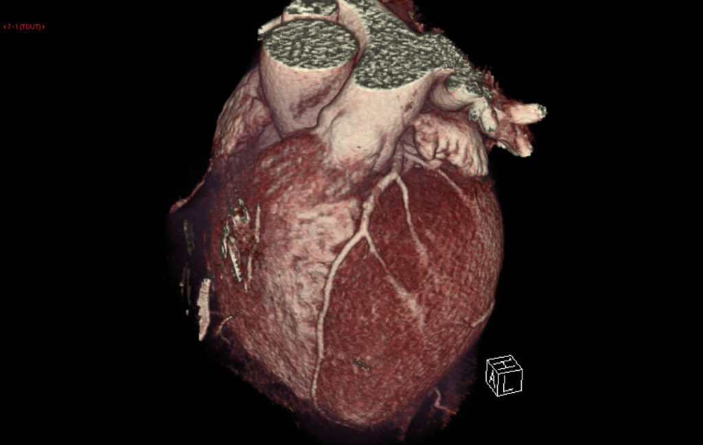 L’apprentissage machine sur un coroscanner permet de mieux prédire les ...