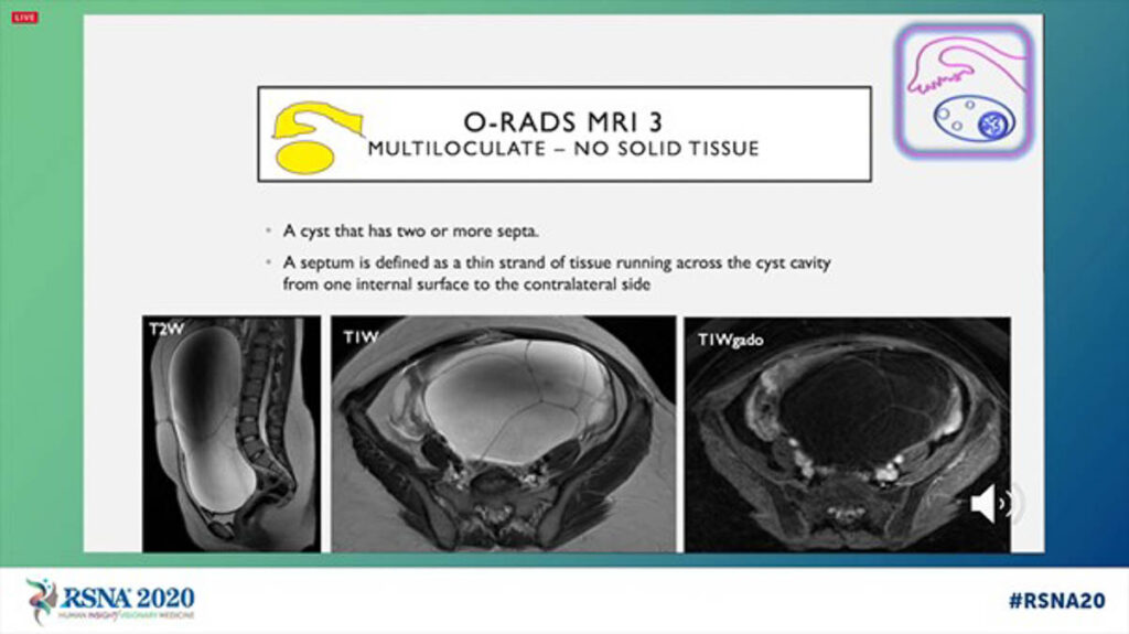 Le score O-RADS, outil déterminant pour la médecine personnalisée ...