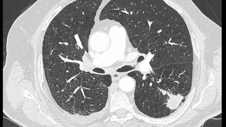 Le dépistage du cancer du poumon en attente de décisions - Docteur Imago