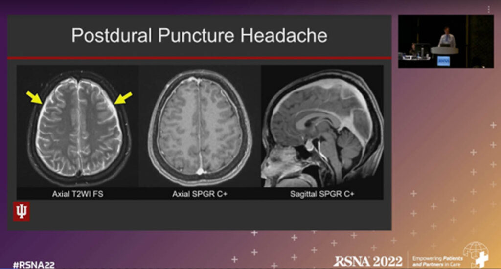 Des complications neurologiques du post-partum à surveiller - Docteur Imago