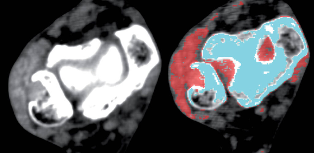 Scanner double énergie : bases de la technique et rôle clinique ...