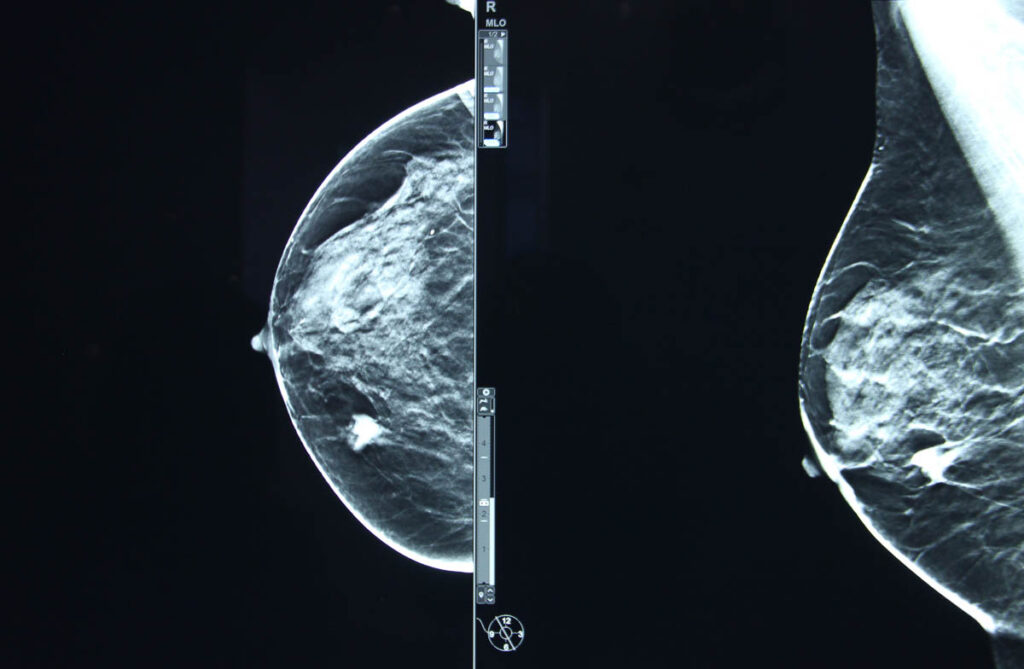 Docteur Résimont Cancer Du Sein – XHJRUO