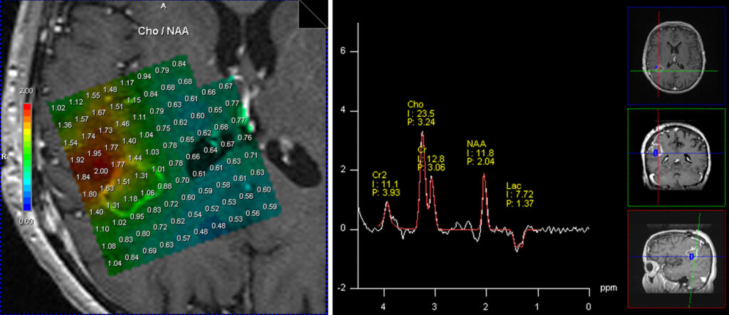 La spectroscopie déploie son potentiel pour le traitement des ...