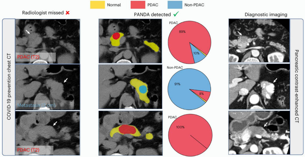 Un modèle d’IA surpasse les radiologues dans la détection du cancer du ...