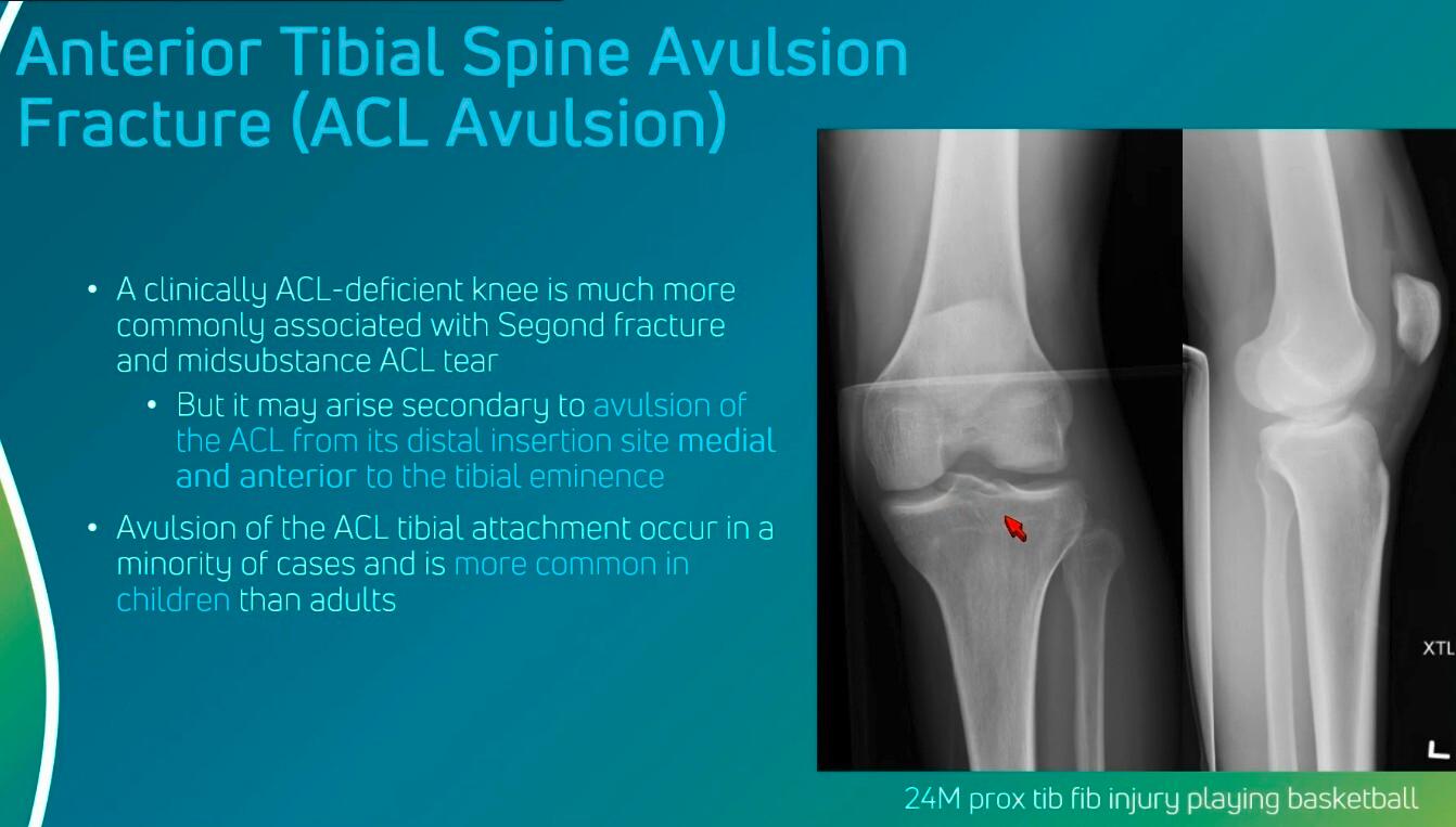 Les lésions subtiles du genou à ne pas manquer - Docteur Imago