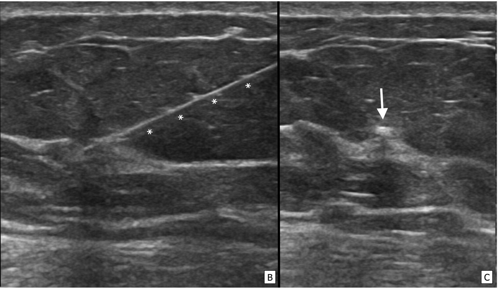 Un système de graines magnétiques prometteur pour localiser les tumeurs du sein non palpables ...