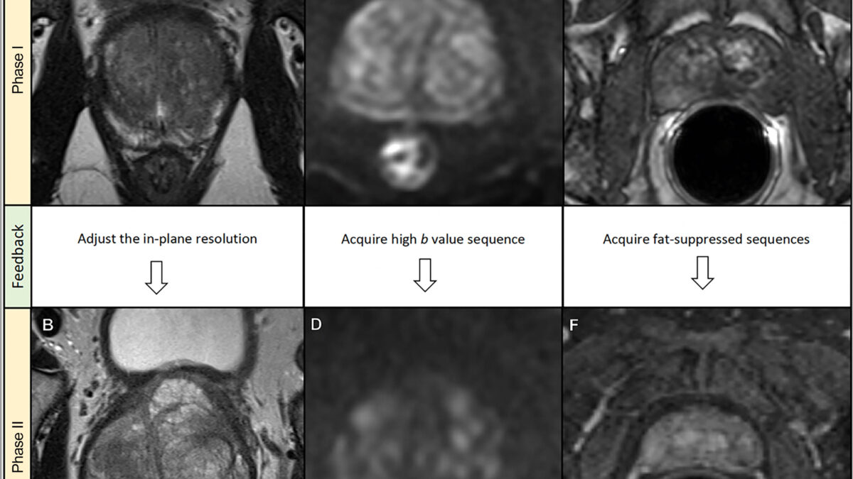 Le score PI-QUAL améliore la qualité variable des IRM de la prostate ...