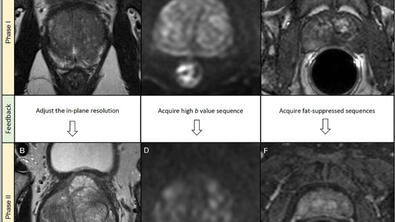 Le score PI-QUAL améliore la qualité variable des IRM de la prostate ...