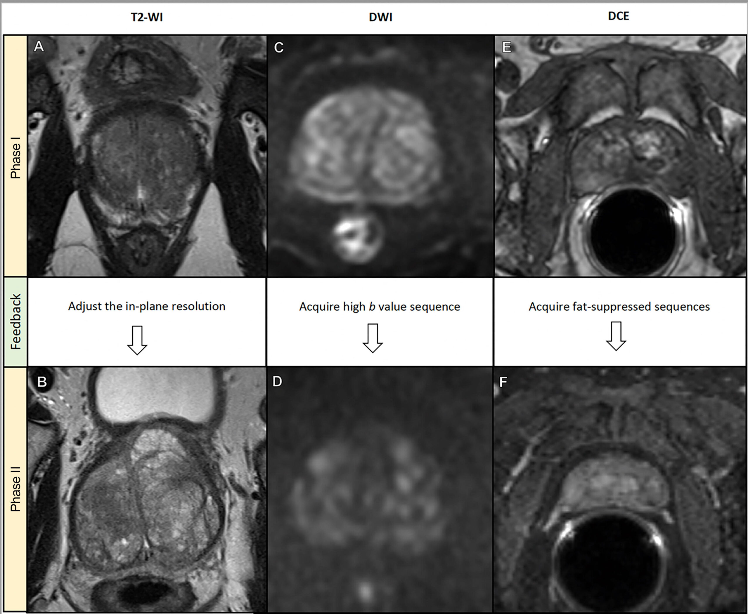 Le score PI-QUAL améliore la qualité variable des IRM de la prostate ...